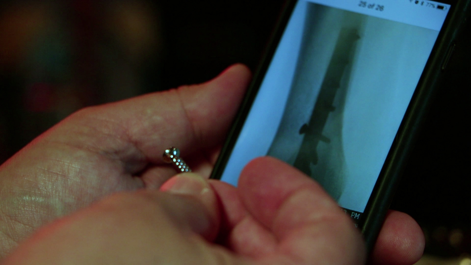 Doctors are developing orthopedic screws that will dissolve inside the ...